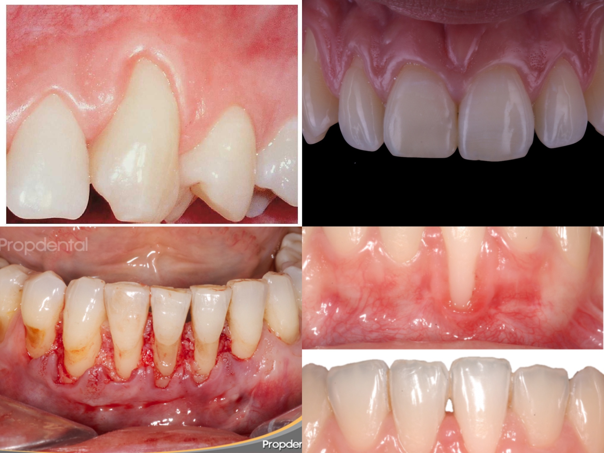 Lo que necesitas saber sobre la recesión gingival – barbierika
