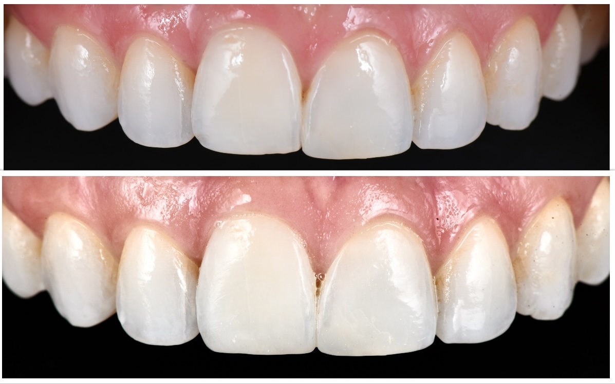 The reconstruction of my tooth with layered composite – barbierika